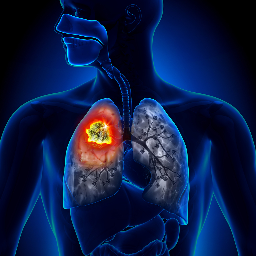NFCR’s Genomics Newsroom: New Lung Cancer Mutation - NFCR