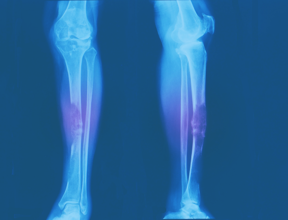 Cancer Types | Sarcoma Cancer - National Foundation for Cancer Research