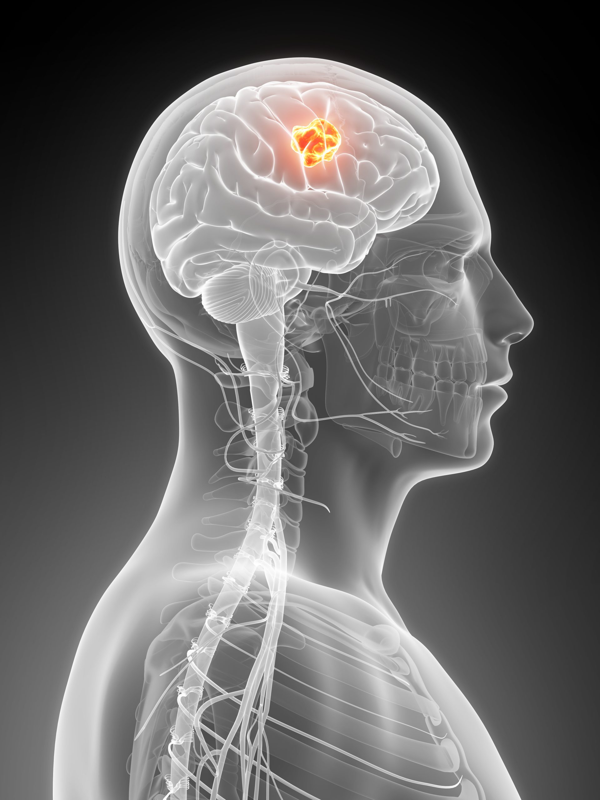greyscale picture of person with brain and tumor highlighted - NFCR