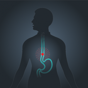 New Test Developed for Pre-Cancerous Esophageal Cancer