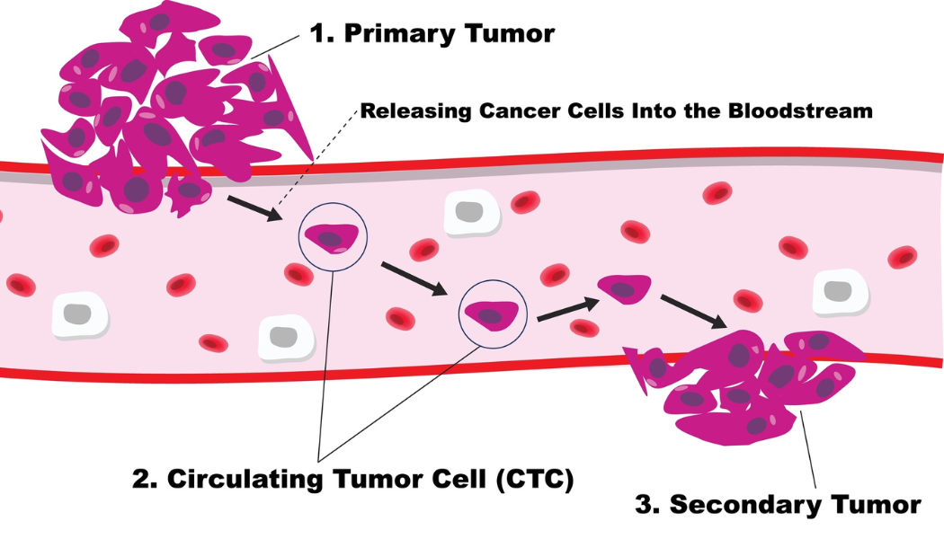 Circulating Tumor Cells - Cancer Research for a Cure